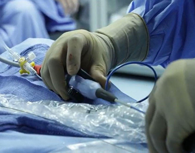 Heart procedure reduces radiation exposure for AFib patients ...
